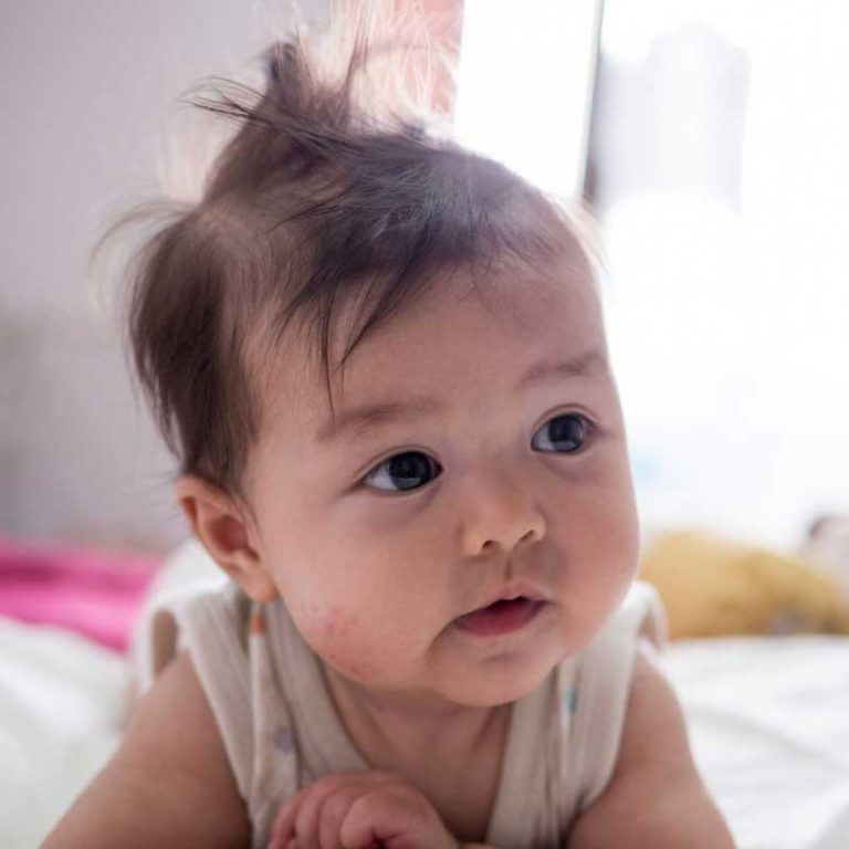 Crveni obrazi kod beba: uzroci i lečenje - Rastimo zdravo