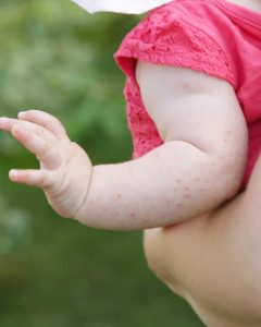 Osip od vrućine kod beba. Naučite da ga prepoznate - Rastimo zdravo